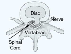 Lumbar Microdiscectomy Spine Surgery | Las Vegas, NV